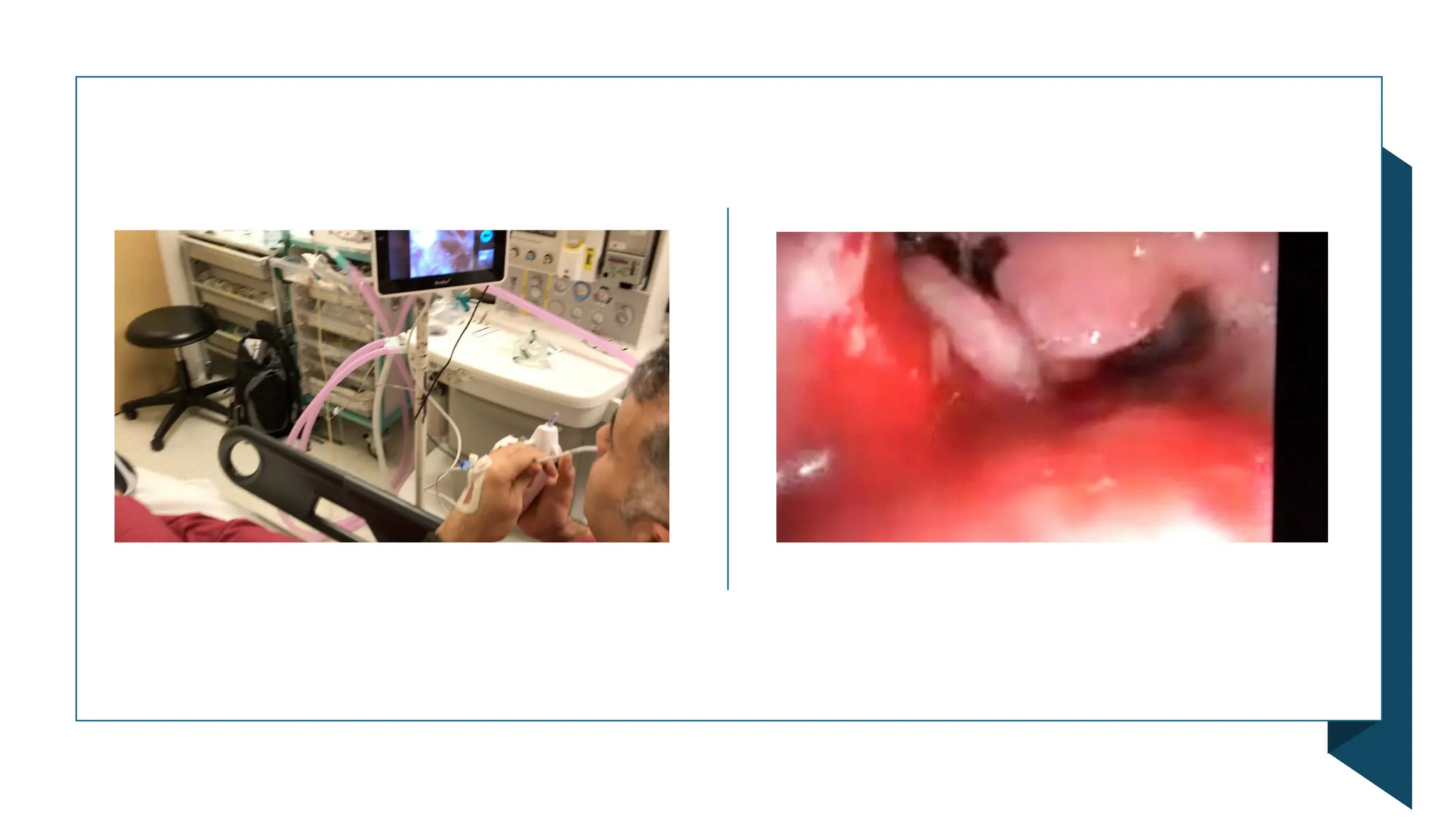 Extubation of difficult airway which includes difficult airway society ...