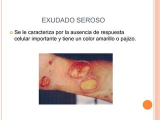 Exudado | PPTX