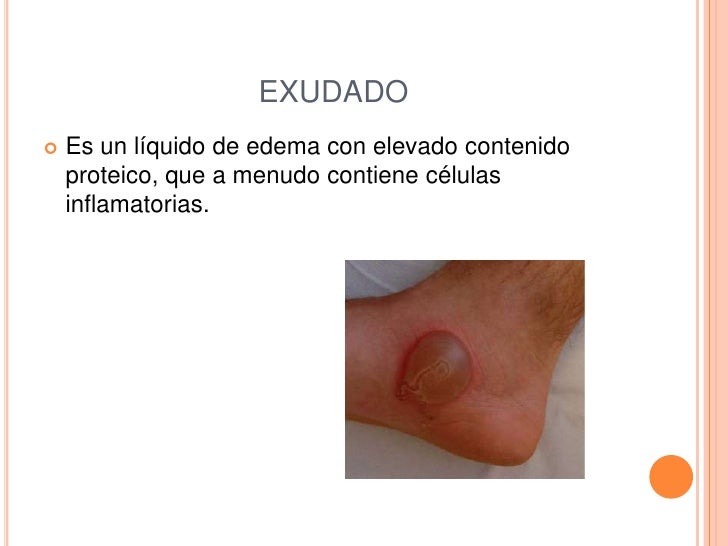 Exudado