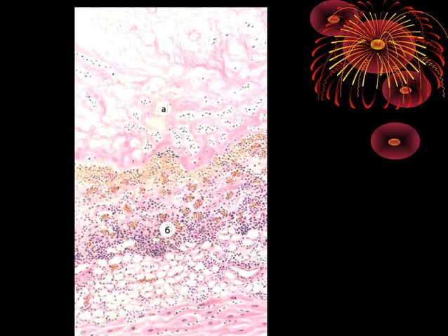 Exudative inflammation | PPT | Digestive Disorders | Diseases and ...