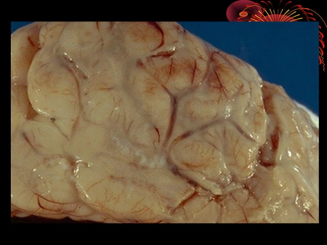 Exudative inflammation | PPT | Digestive Disorders | Diseases and ...