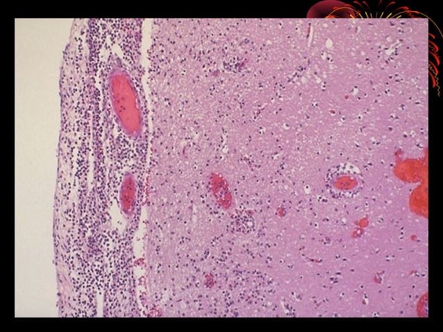 Exudative inflammation | PPT | Digestive Disorders | Diseases and ...