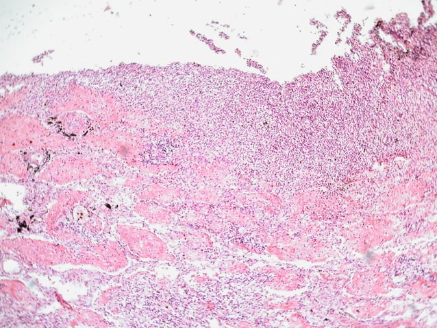 Exudative inflammation | PPT | Digestive Disorders | Diseases and ...