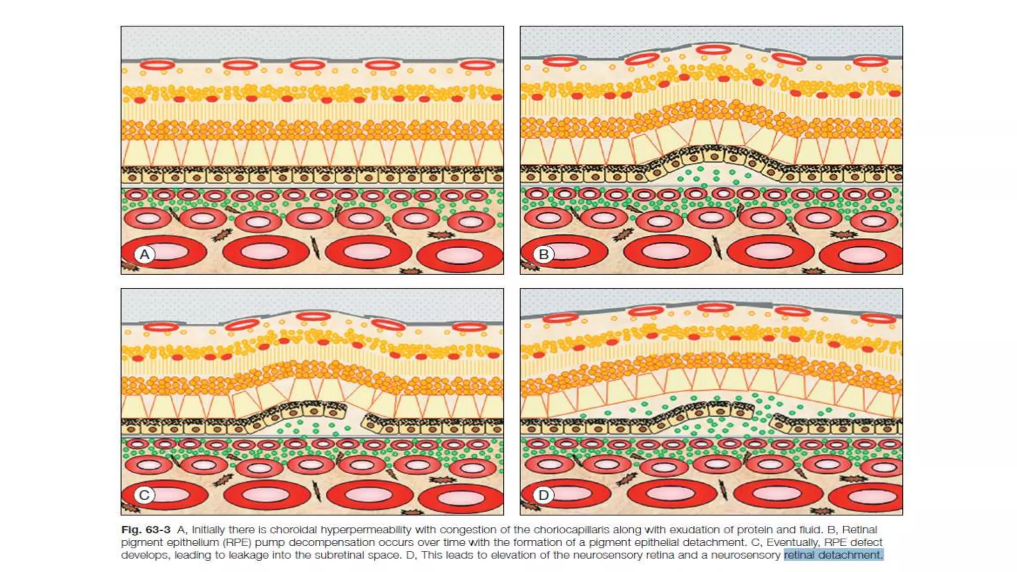 Exudative Retinal Detachment- Etiopathogenesis | PPTX