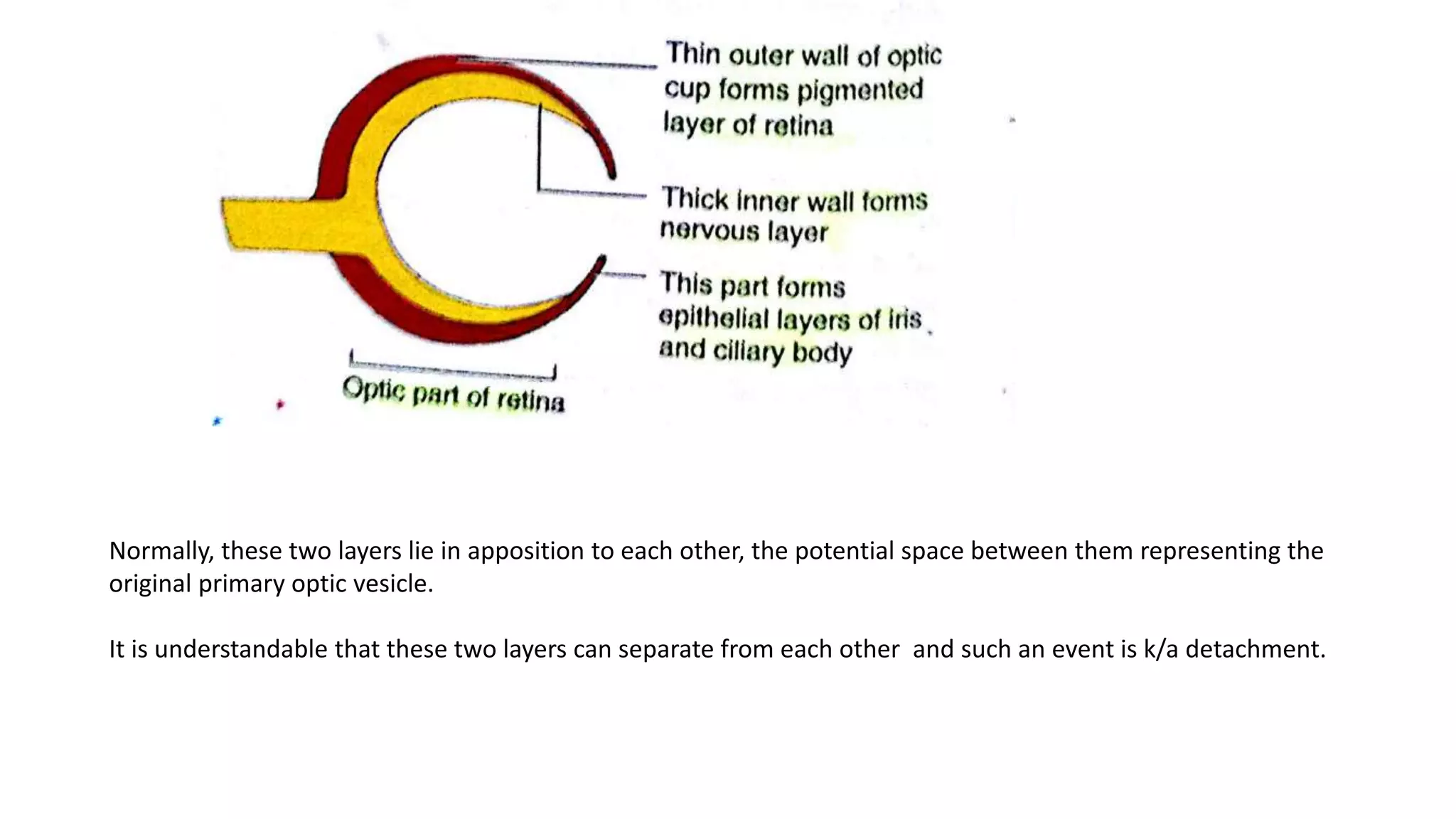 Exudative Retinal Detachment- Etiopathogenesis | PPTX