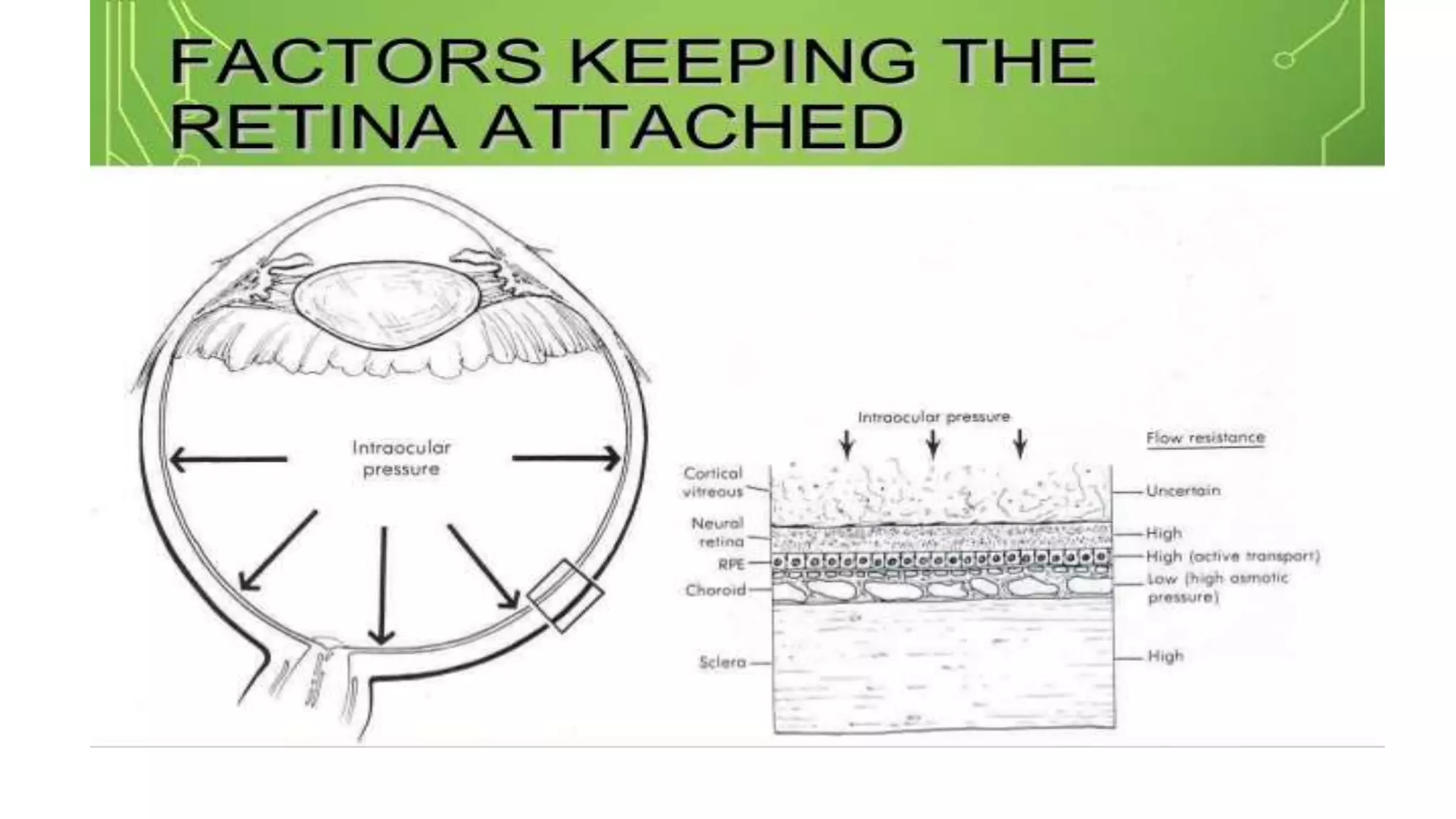 Exudative Retinal Detachment- Etiopathogenesis | PPTX