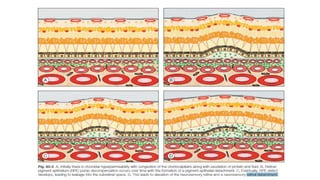 Exudative Retinal Detachment- Etiopathogenesis | PPTX