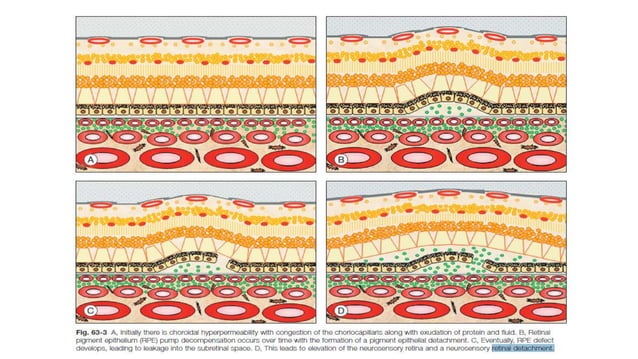 Exudative Retinal Detachment- Etiopathogenesis | PPTX