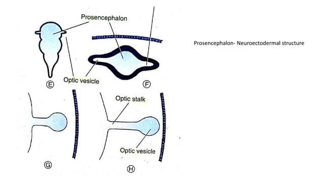 Exudative Retinal Detachment- Etiopathogenesis | PPT