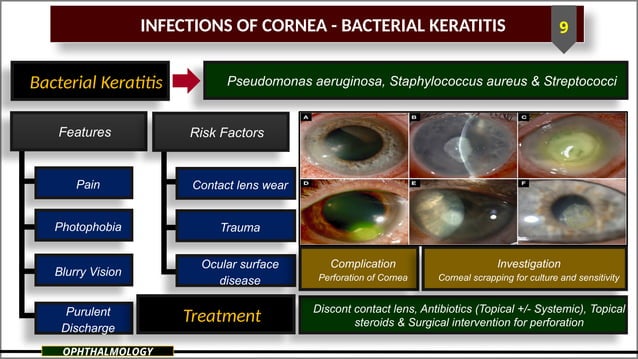Infections of Eyelid Cornea Conjectiva and Uveitis.pptx