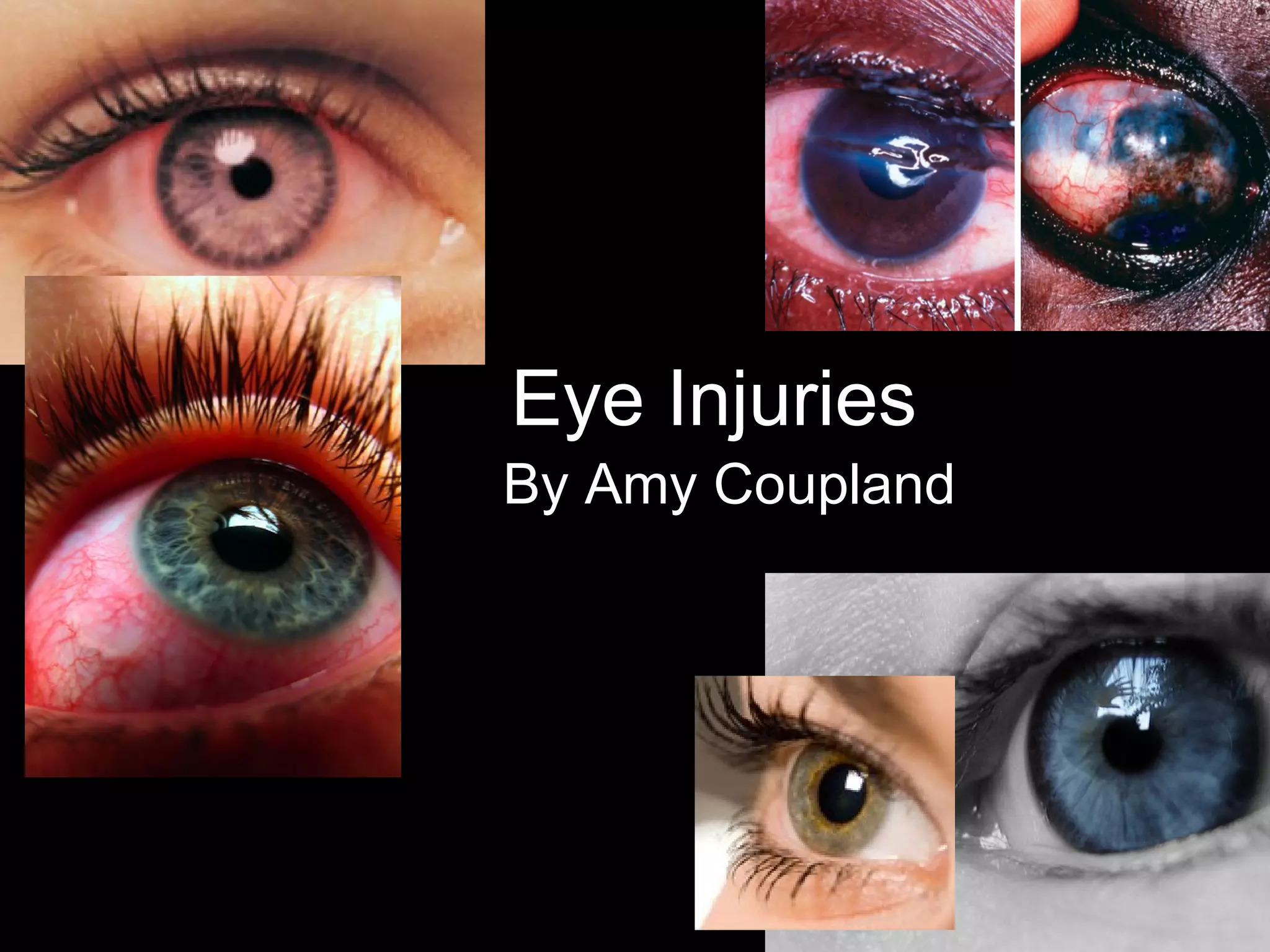Eye Injuries | PPT