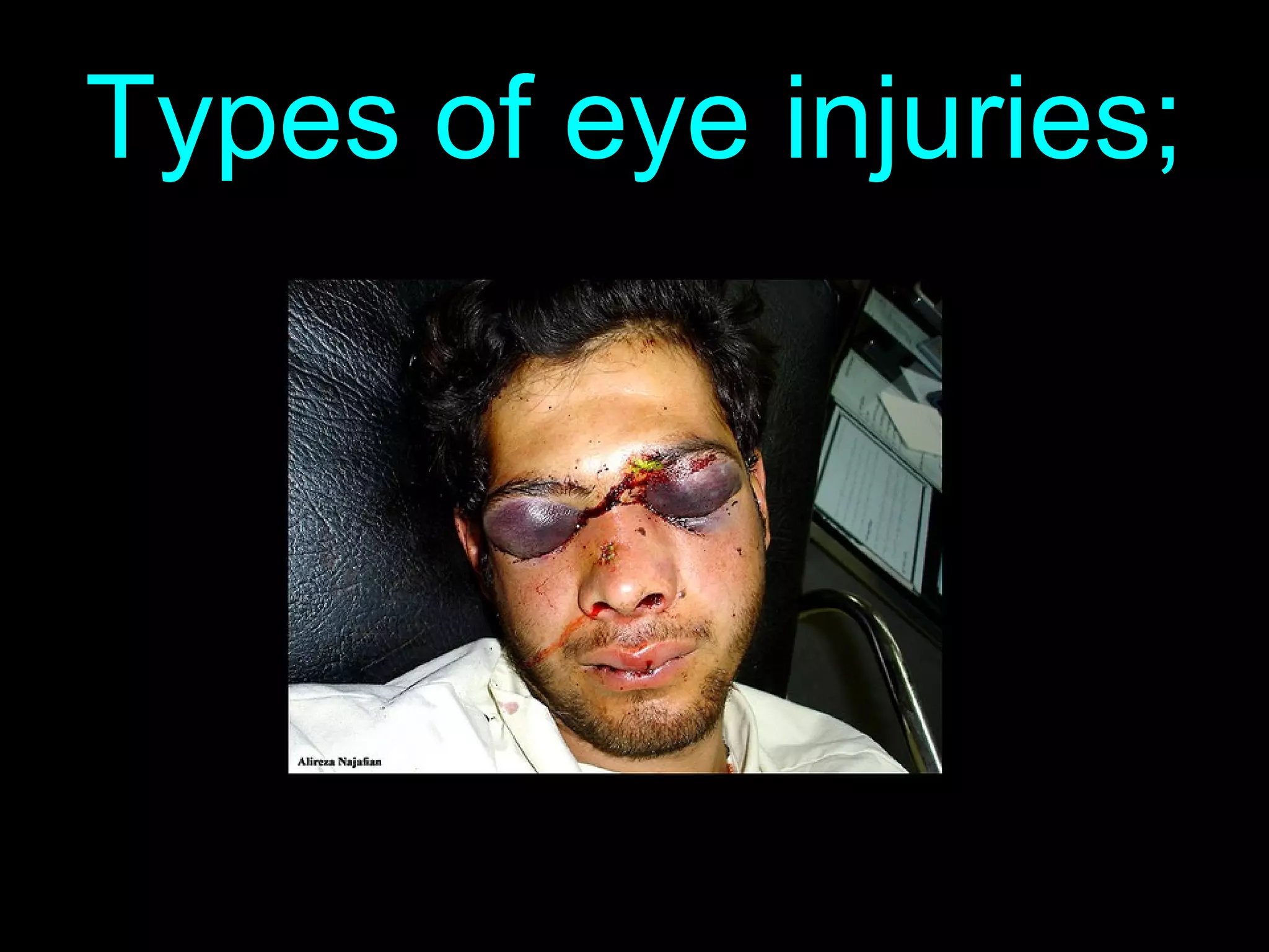 Eye Injuries | PPT
