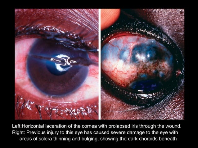 Eye Injuries | PPT