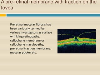EYE-OCT.(OPTICAL COHERANCE TOMOGRAPHY) | PPTX