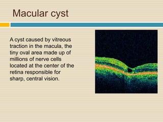 EYE-OCT.(OPTICAL COHERANCE TOMOGRAPHY) | PPTX