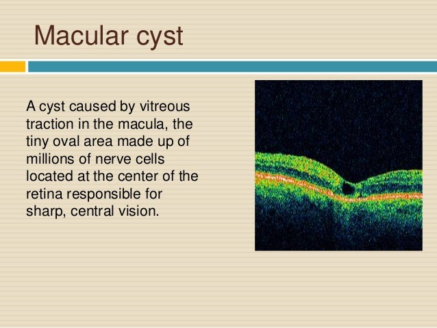 EYE-OCT.(OPTICAL COHERANCE TOMOGRAPHY)