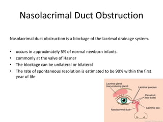 Nasolacrimal Duct Obstruction | PPTX