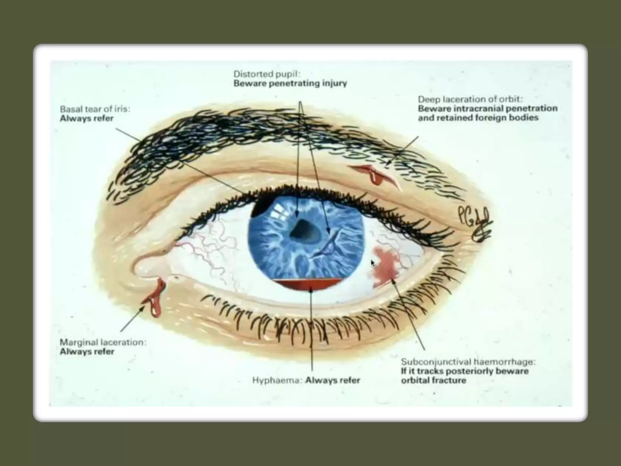Eye trauma for Dentists | PPTX