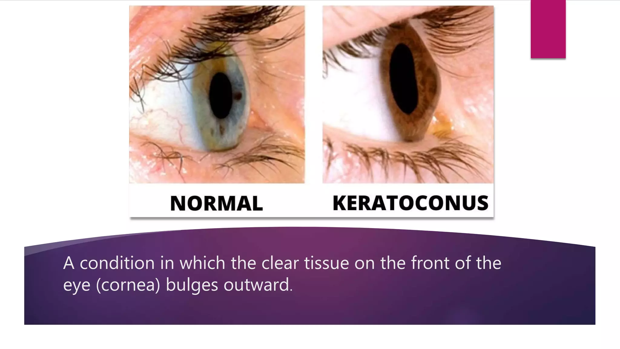 Eye Bandaging Nursing Procedure | PPTX
