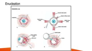 eye bank for ophthalmology medical students | PPTX