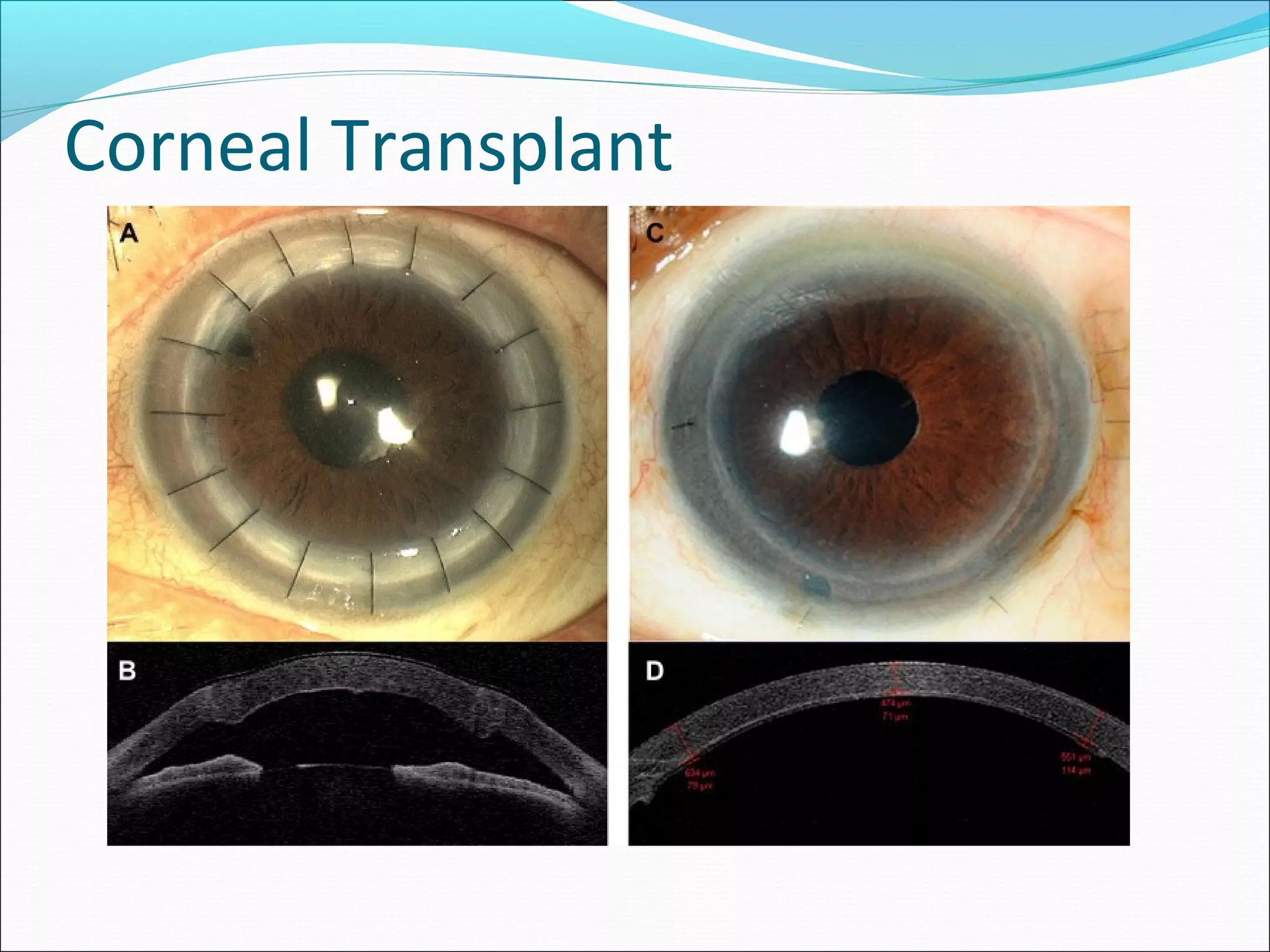 Eye banking and corneal transplantation 10.03.16,dr.k.n.jha