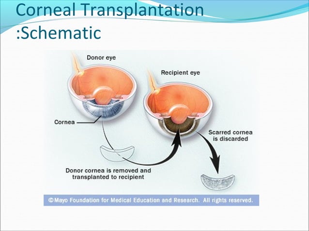 Eye banking and corneal transplantation 10.03.16,dr.k.n.jha | Eye and ...