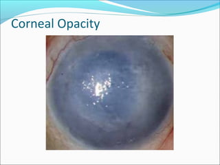 Eye banking and corneal transplantation 10.03.16,dr.k.n.jha
