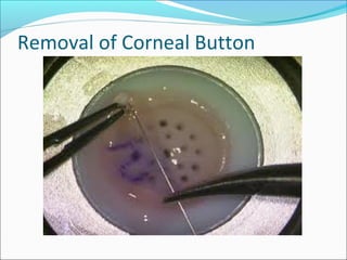 Eye banking and corneal transplantation 10.03.16,dr.k.n.jha