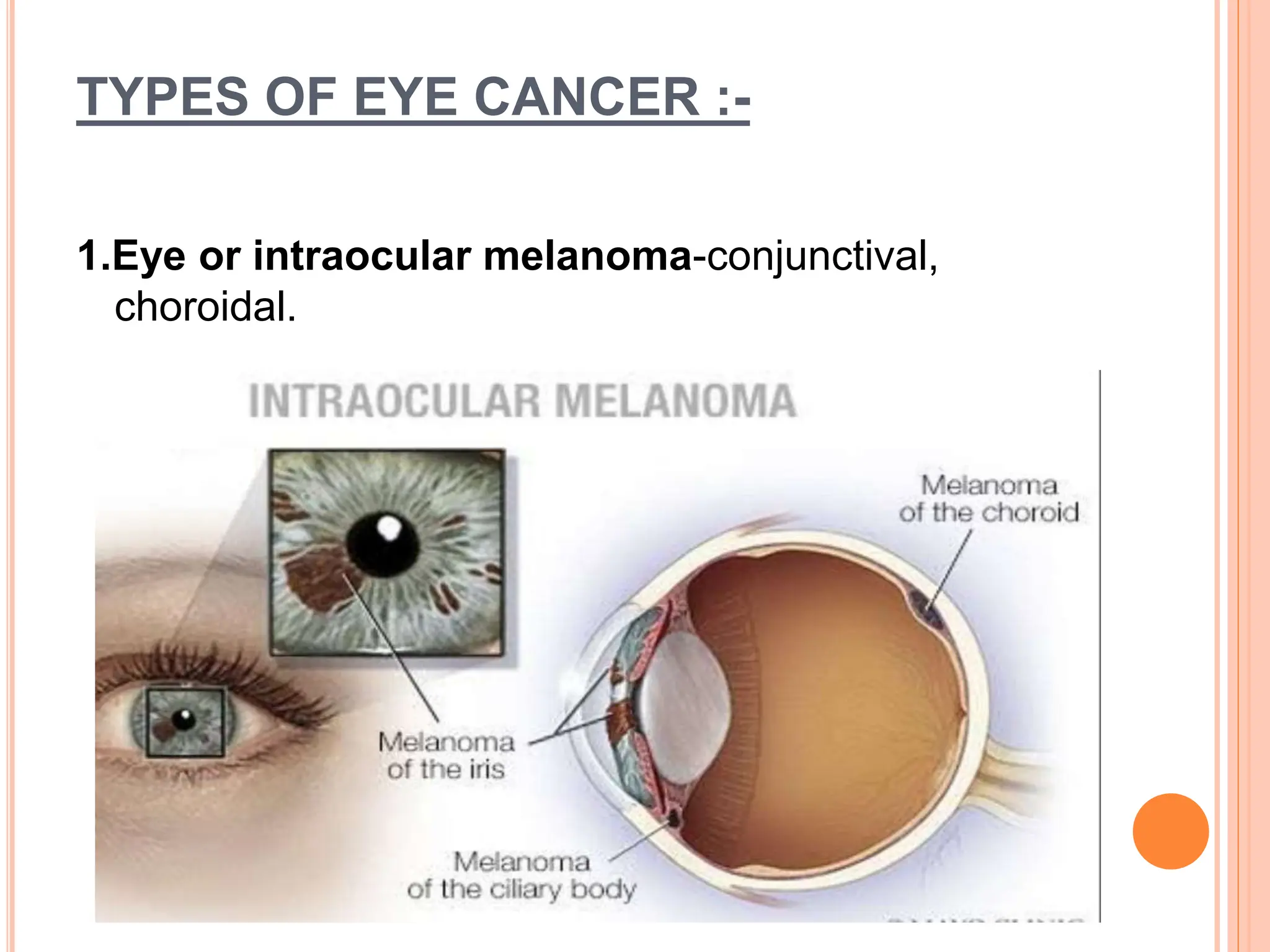 EYE CANCER.pptx prepared by Neha kewat digital learning | PPTX