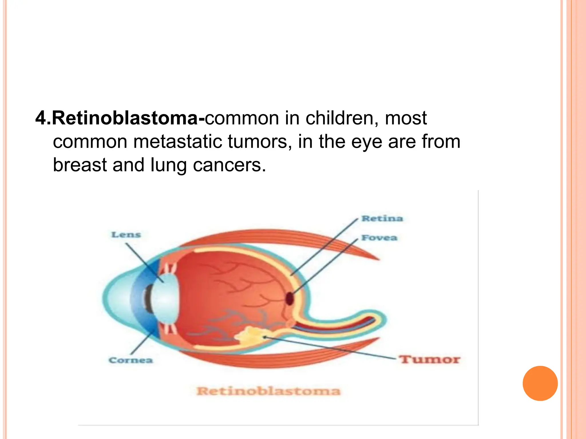 EYE CANCER.pptx prepared by Neha kewat digital learning | PPTX
