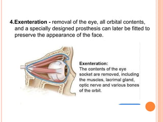 EYE CANCER.pptx prepared by Neha kewat digital learning | PPTX