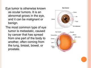 EYE CANCER.pptx prepared by Neha kewat digital learning | PPTX