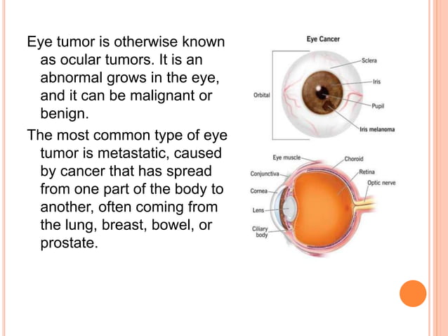EYE CANCER.pptx prepared by Neha kewat digital learning | PPTX