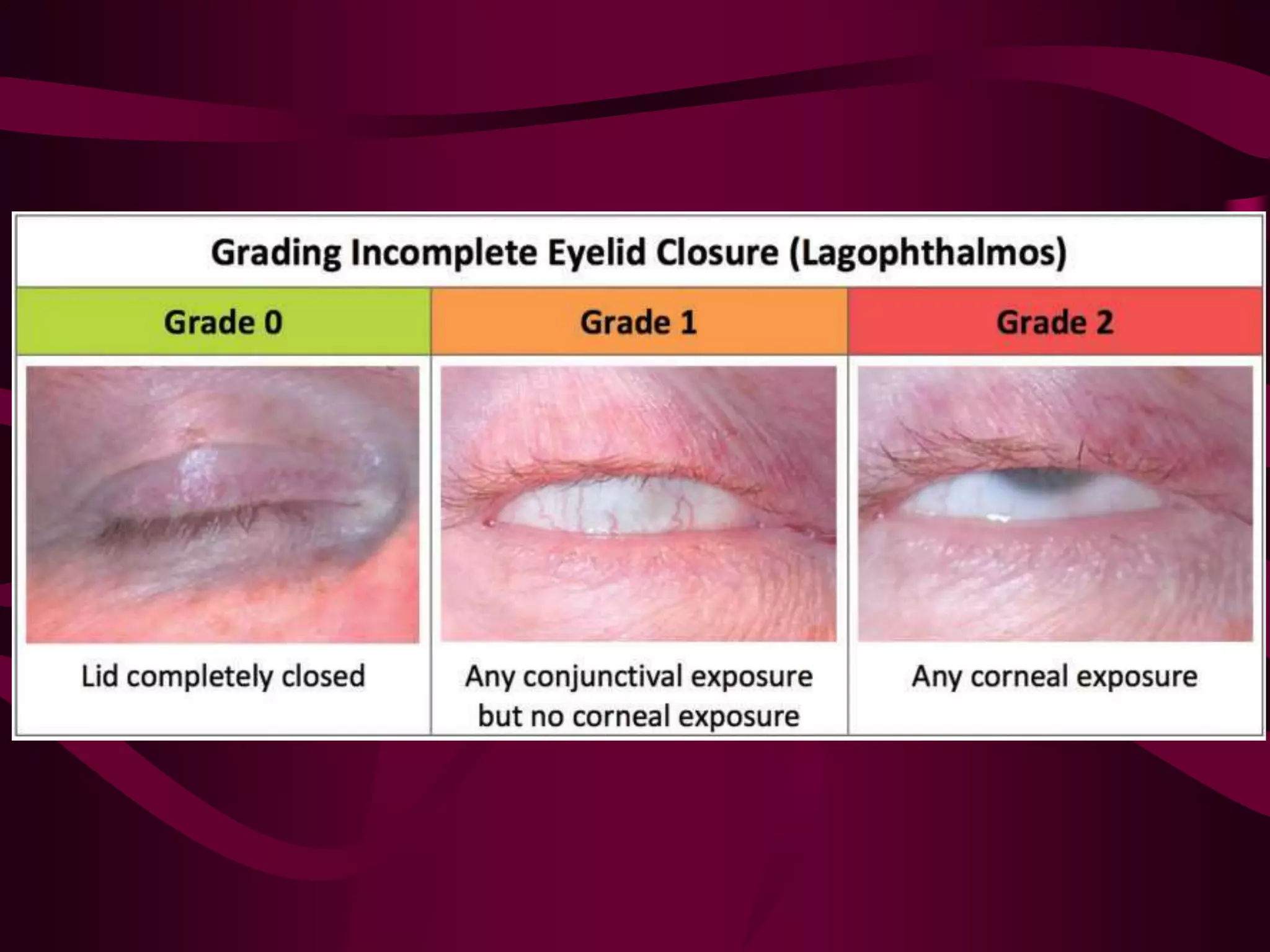 Eye care tips in ICU | PPT