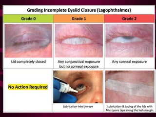 Eye care tips in ICU | PPT