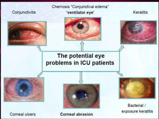 Eye care tips in ICU | PPT