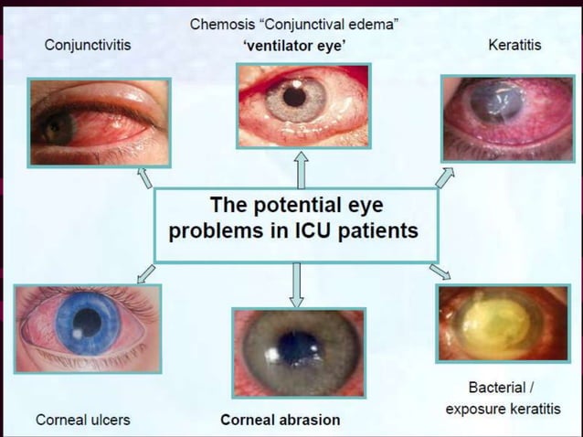 Eye care tips in ICU | PPT