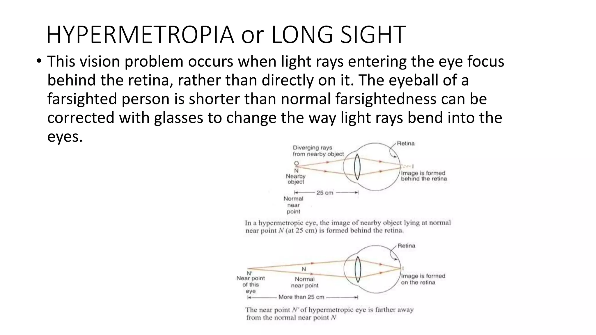 Eye defects | PPTX