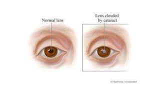 Eye defects | PPTX