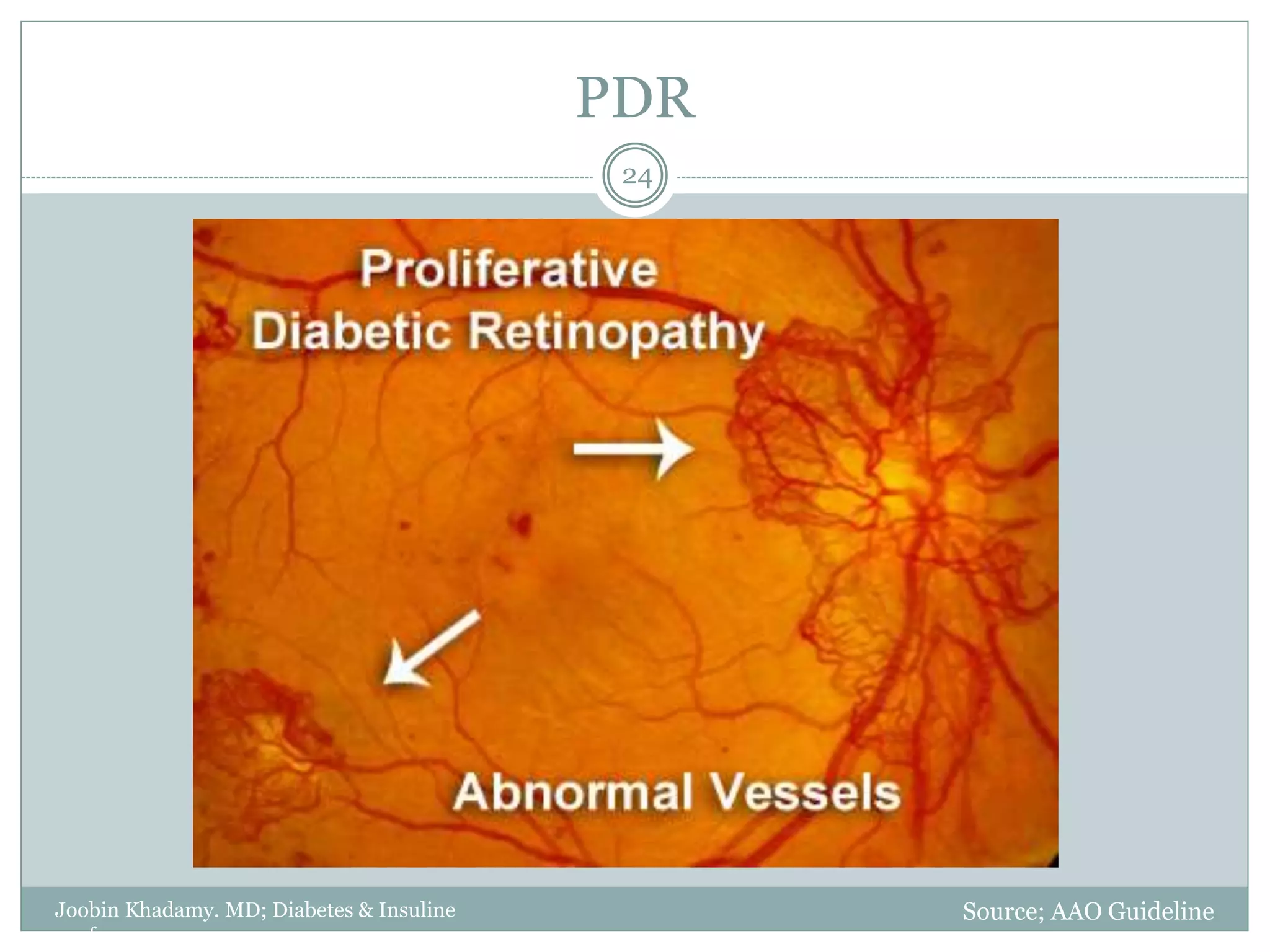 Ocular Manifestation of Diabetes Mellitus | PPTX