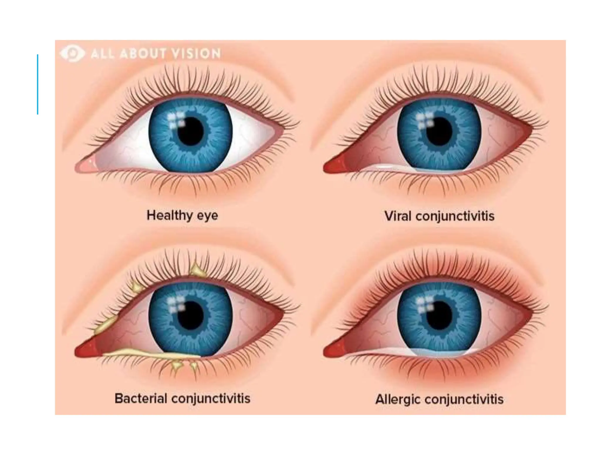 common eye diseases powerpoint presentation | PPTX