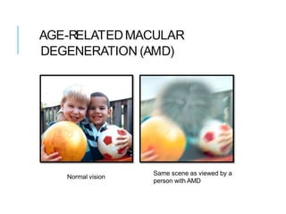 common eye diseases powerpoint presentation | PPTX