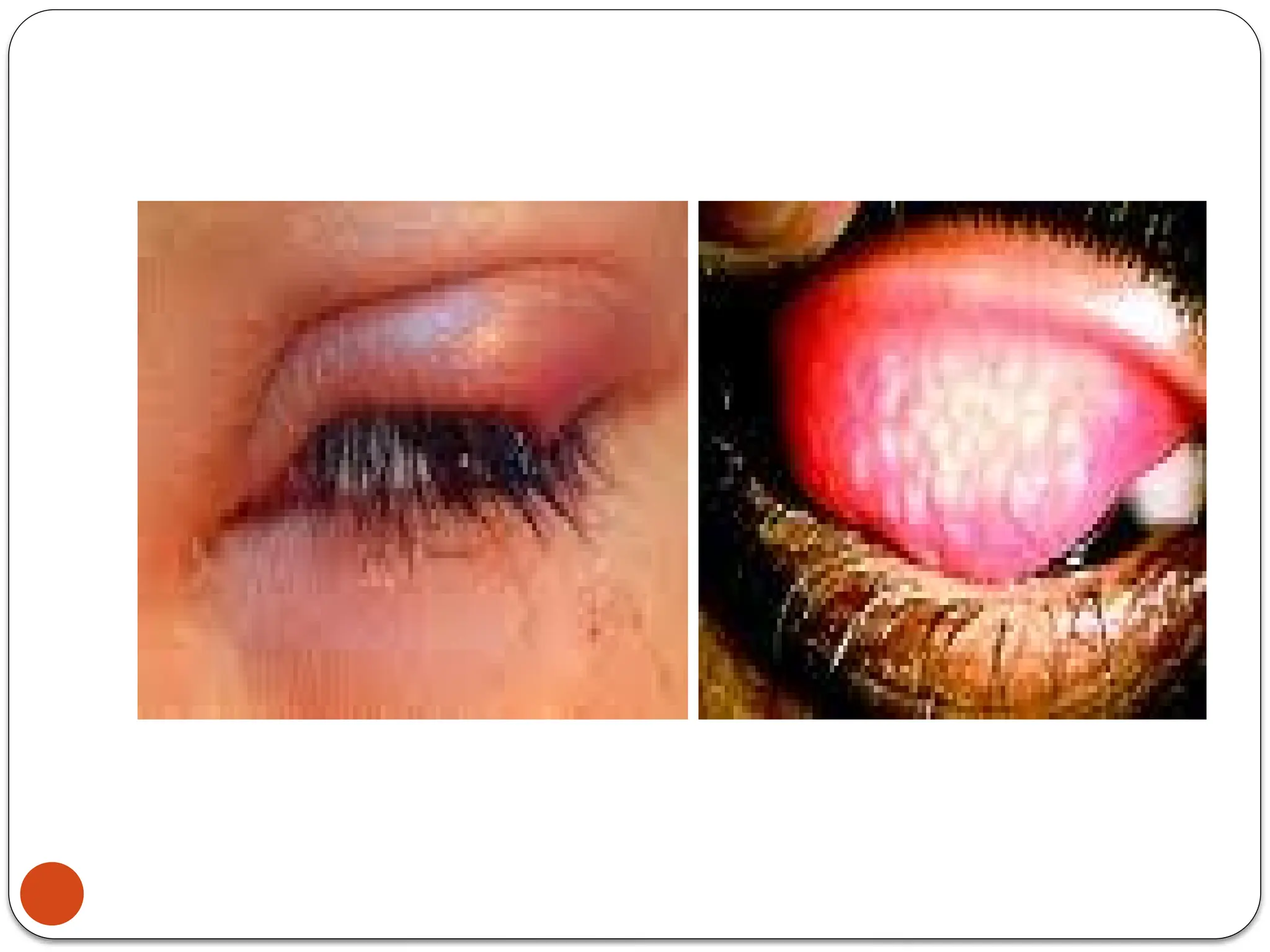 Eye disorder- Medical surgical Nursing.pptx