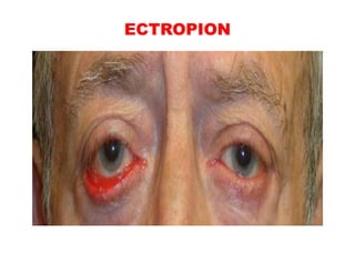 Eye disorders | PDF