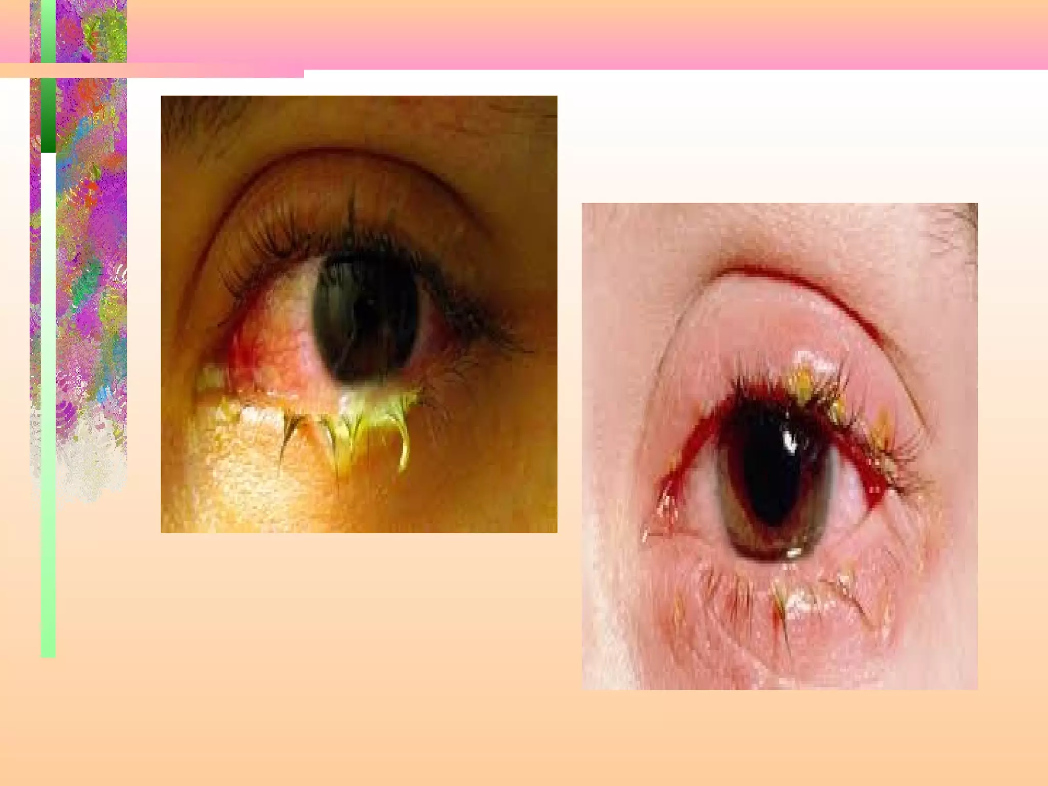 Eye diseases & disorders | PPT