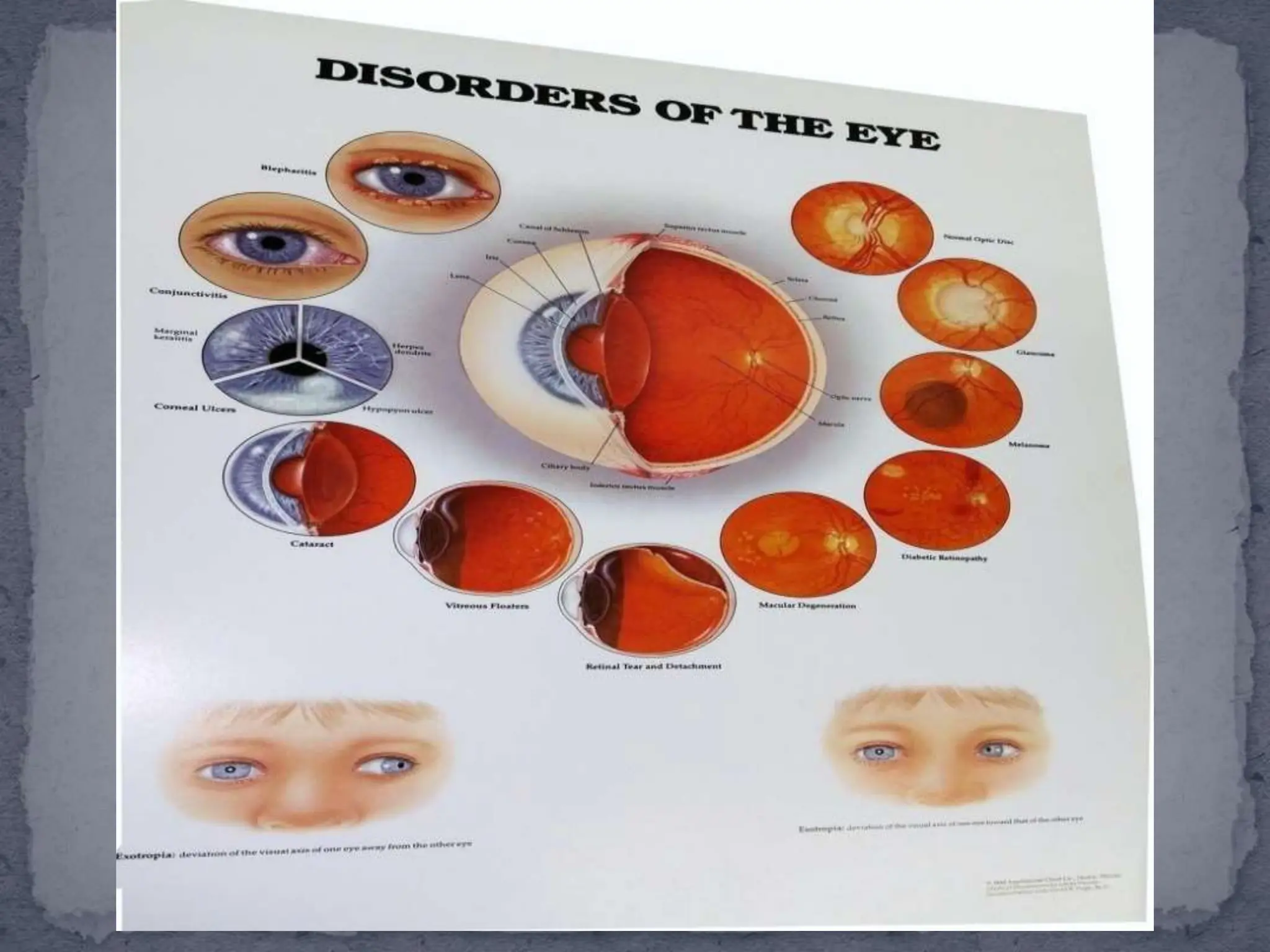 eye disorders .pptx