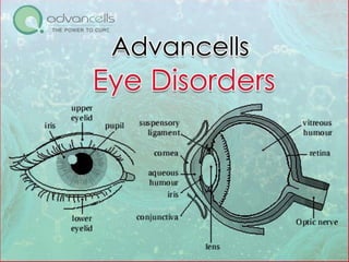 Eye disorders ppt | PPTX