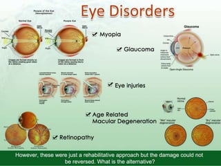 Eye disorders ppt | PPTX