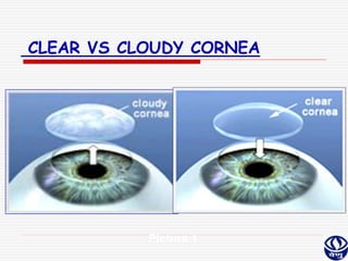 Eye donation | PPTX
