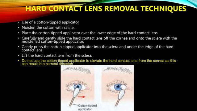 Eye drop or ointment placement. Ocular burn.contact lens.pptx